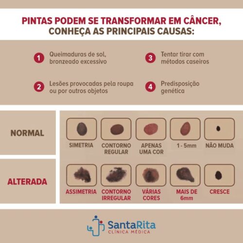 Pintas podem se tornar câncer? - Santa Rita Clínica Médica